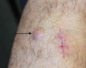 What Does the Local Recurrence of Melanoma Look Like? » Scary Symptoms