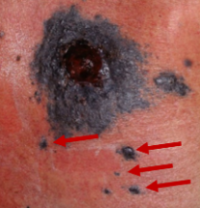 What Does the Local Recurrence of Melanoma Look Like? » Scary Symptoms