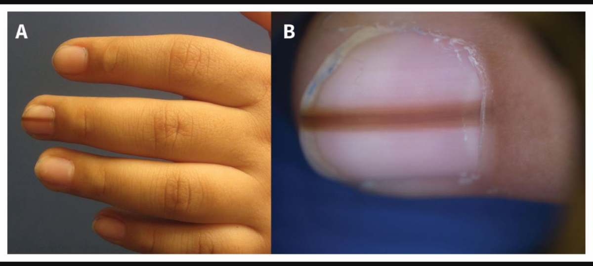 6 Year Old’s Nail Mole Likely Melanoma or just a Birth Mark? » Scary ...