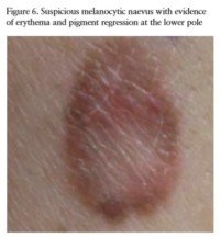 Severely Atypical Mole with Regression: Time to Worry » Scary Symptoms