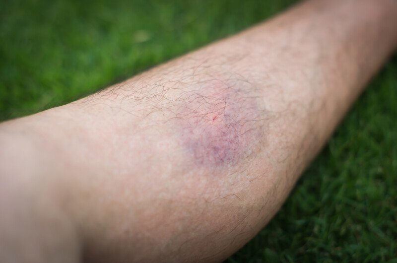 Can a DVT Cause a Bruise Like the Ones We See Often? » Scary Symptoms