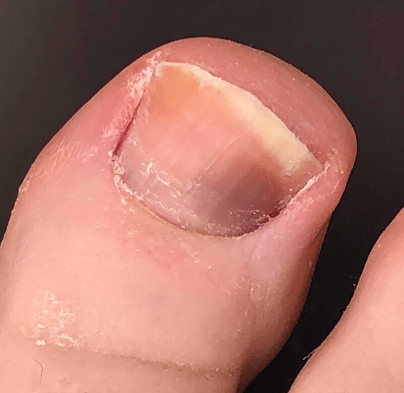 Big Toenail Subungual Hematoma: Images Show Healing Over Time » Scary ...
