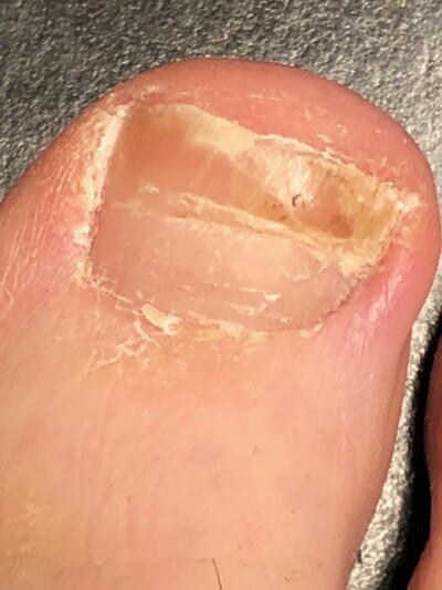 Big Toenail Subungual Hematoma: Images Show Healing Over Time » Scary ...