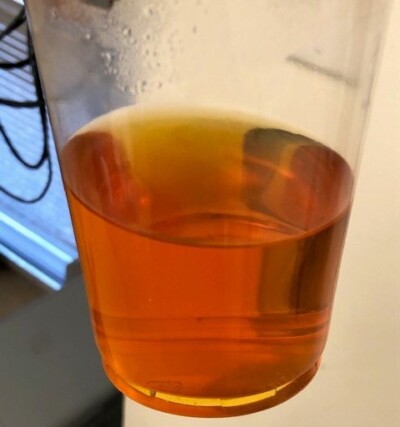 Hydrated but Urine Is Still a Deep Amber Like a Sunset? » Scary Symptoms