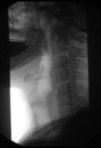 Can A Barium Swallow Test Rule Out Esophageal Cancer Scary Symptoms