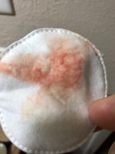 Bleeding After Uterine Biopsy: Might this Mean Cancer? » Scary Symptoms