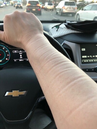 Skin Indents All Over Your Arm from a Tight Sleeve » Scary Symptoms