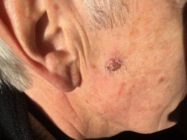 A Doctor's Own Experience with Aggressive Skin Cancer » Scary Symptoms