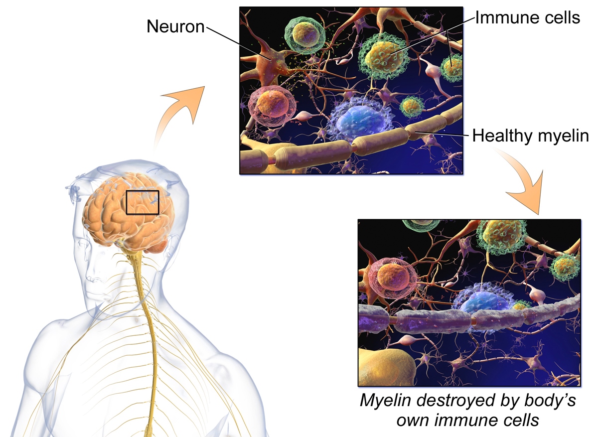 How Hip Pain from MS Feels Different from Other Causes » Scary Symptoms