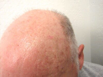 Are Black Bald Men At Risk For Scalp Skin Cancer Scary Symptoms