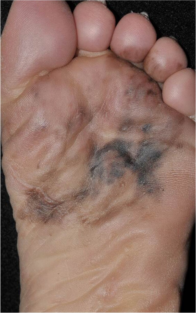 How to Inspect Your Toes and Feet for Melanoma » Scary Symptoms
