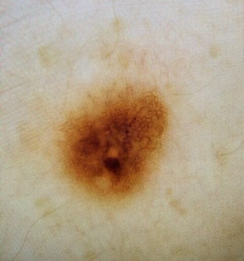 New Solid Dark Spot on a Mole: Could this Be Benign? » Scary Symptoms