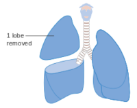 Precision Surgery for Lung Cancer » Scary Symptoms